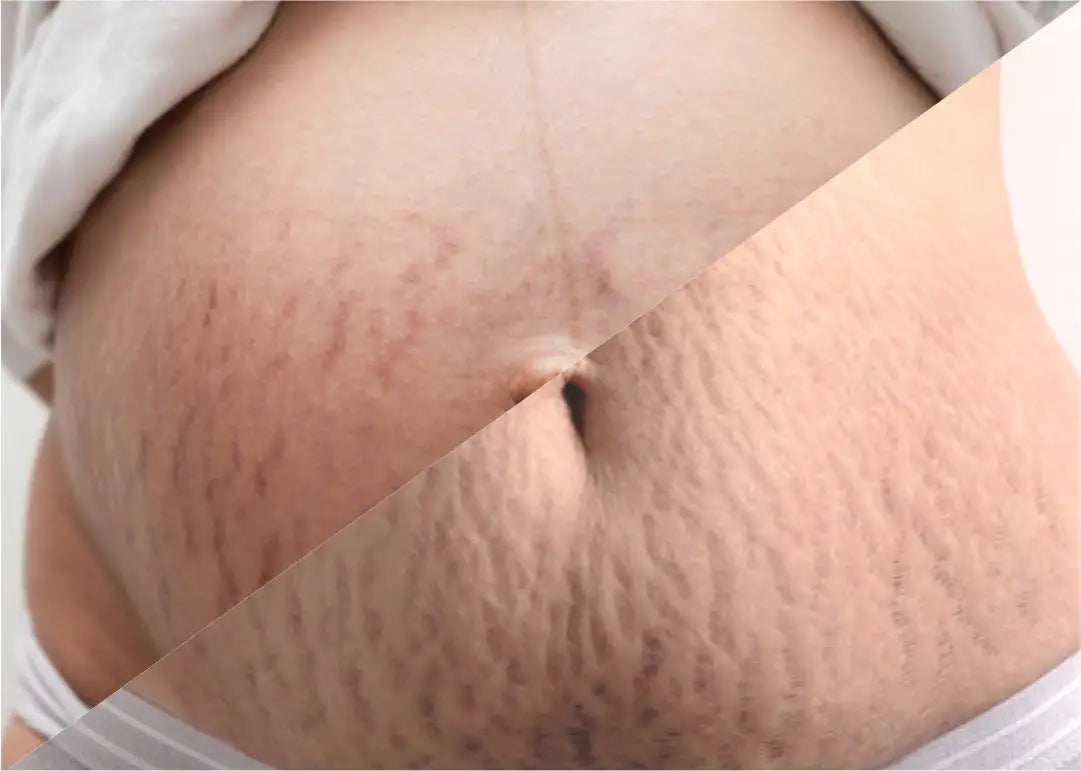 abdominal stretch marks