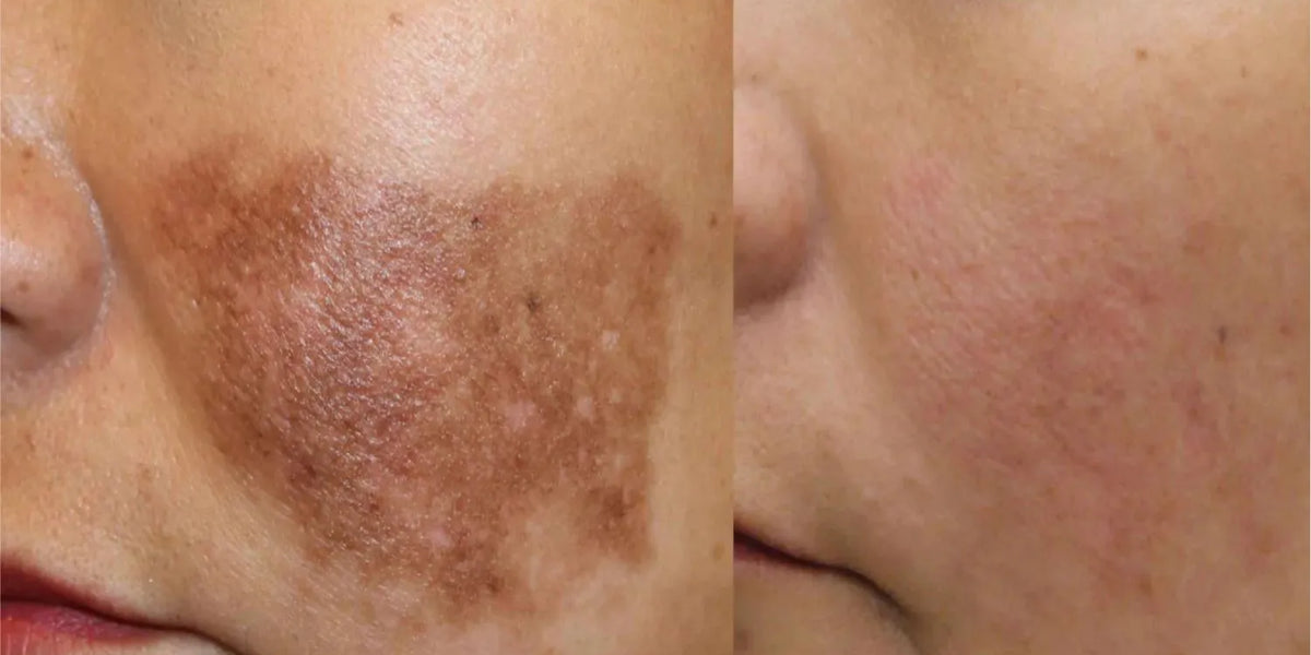 How_to_remove_pigmentation_permenentaly_1501x1071_crop_center_935ca456-d84f-41ef-80b9 ...